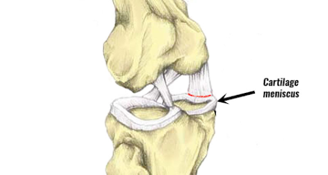 Can A Meniscus Tear Heal On Its Own? - ProPhysio+