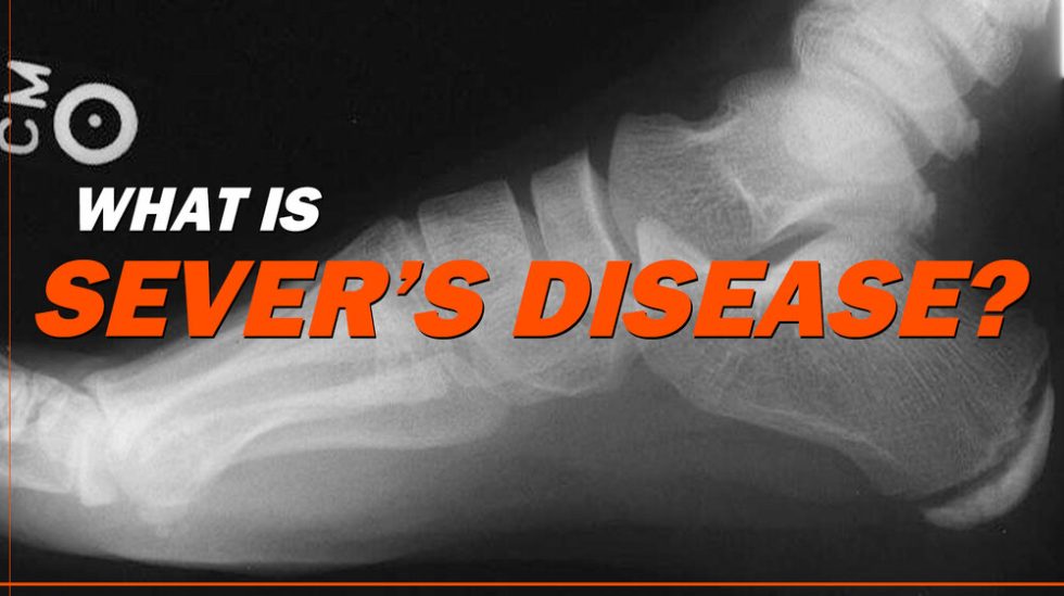 Sever’s Disease - ProPhysio+